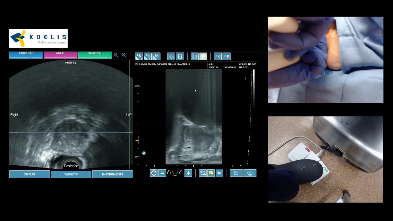 SpaceOAR Injection with KOELIS Trinity & PrecisionPoint Transperineal ...
