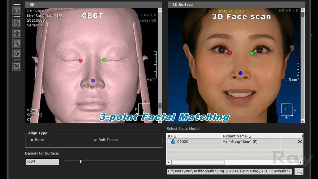3D Ceph Analysis with 3D Face scan - YouTube