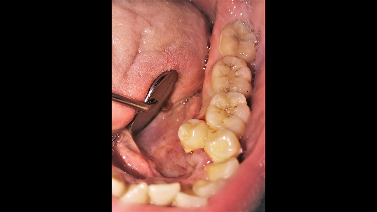tips and tricks for malposed lower second premolar - YouTube