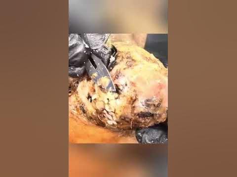 satisfying videos, jiggers removal and cleaning, jiggers digging - YouTube