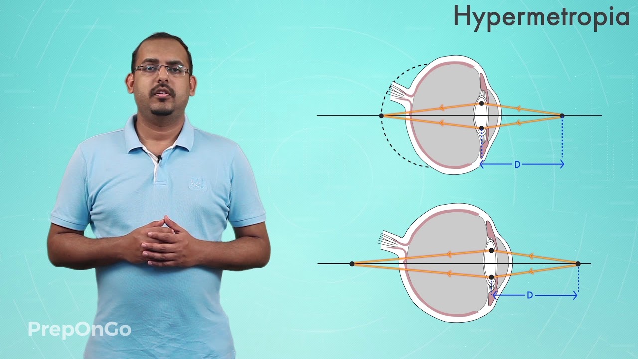 Human Eye and Colourful World - 4 | Defects of the human eye ...