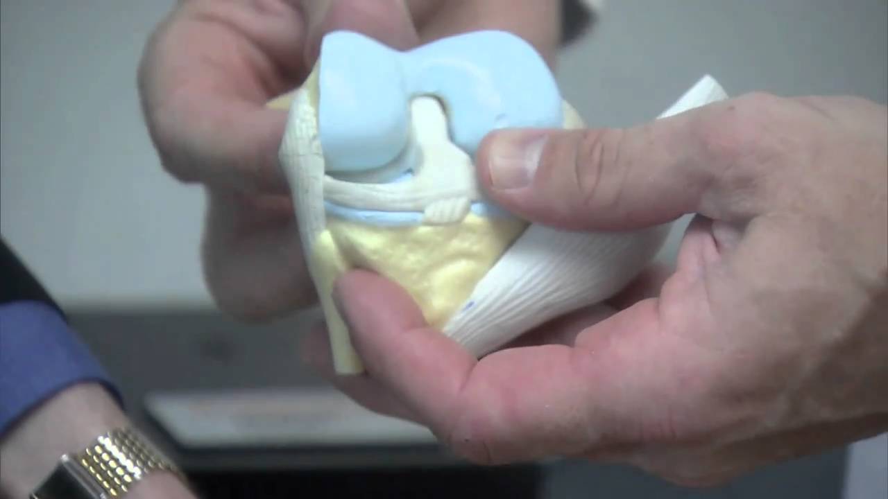 Penn Joint Replacement Service -- Overview by Dr. Craig Israelite - YouTube