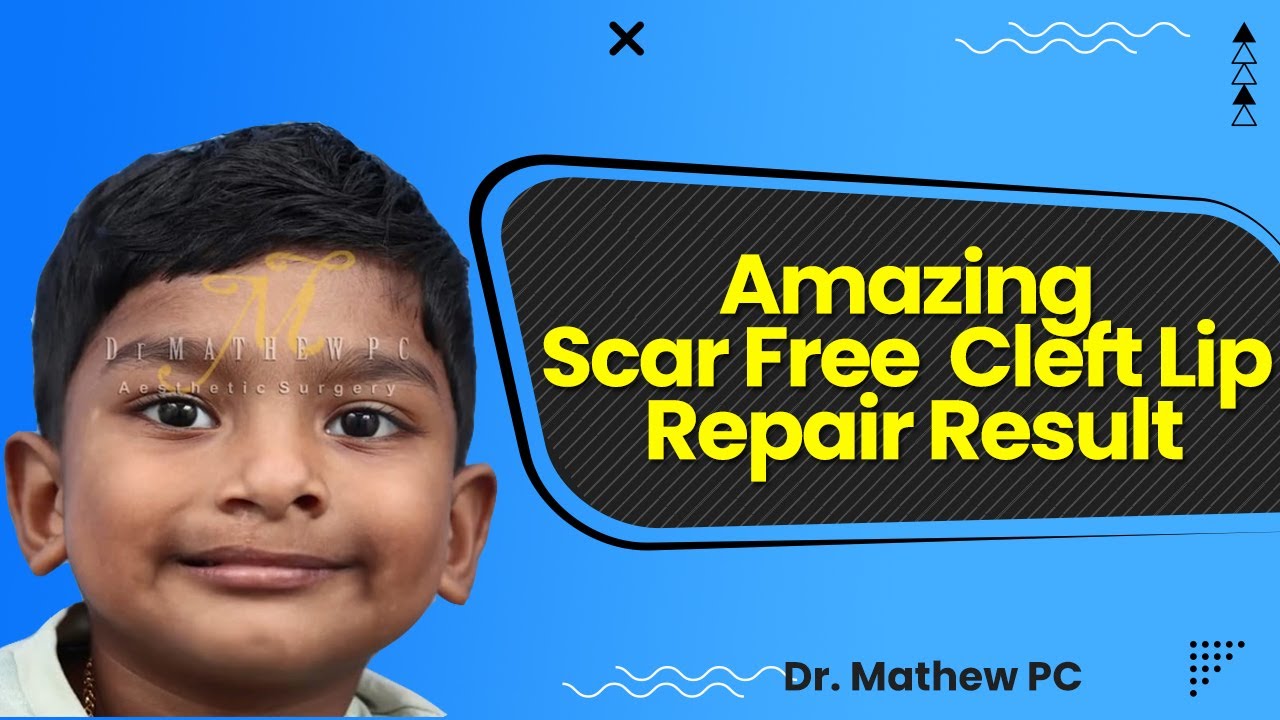 Amazing Scar - Free Cleft Lip Repair Result - New Face With Beautiful ...