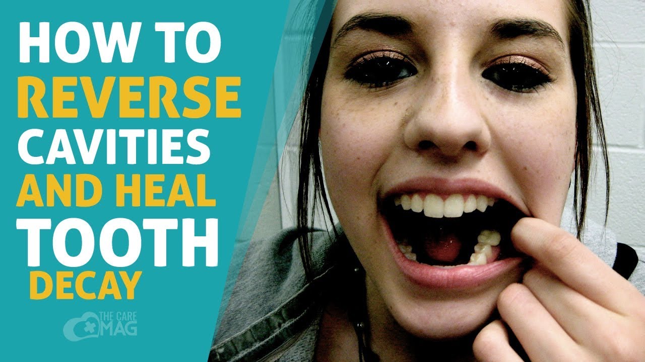 How to Reverse Cavities and Heal Tooth Decay | How to Reverse Cavities ...