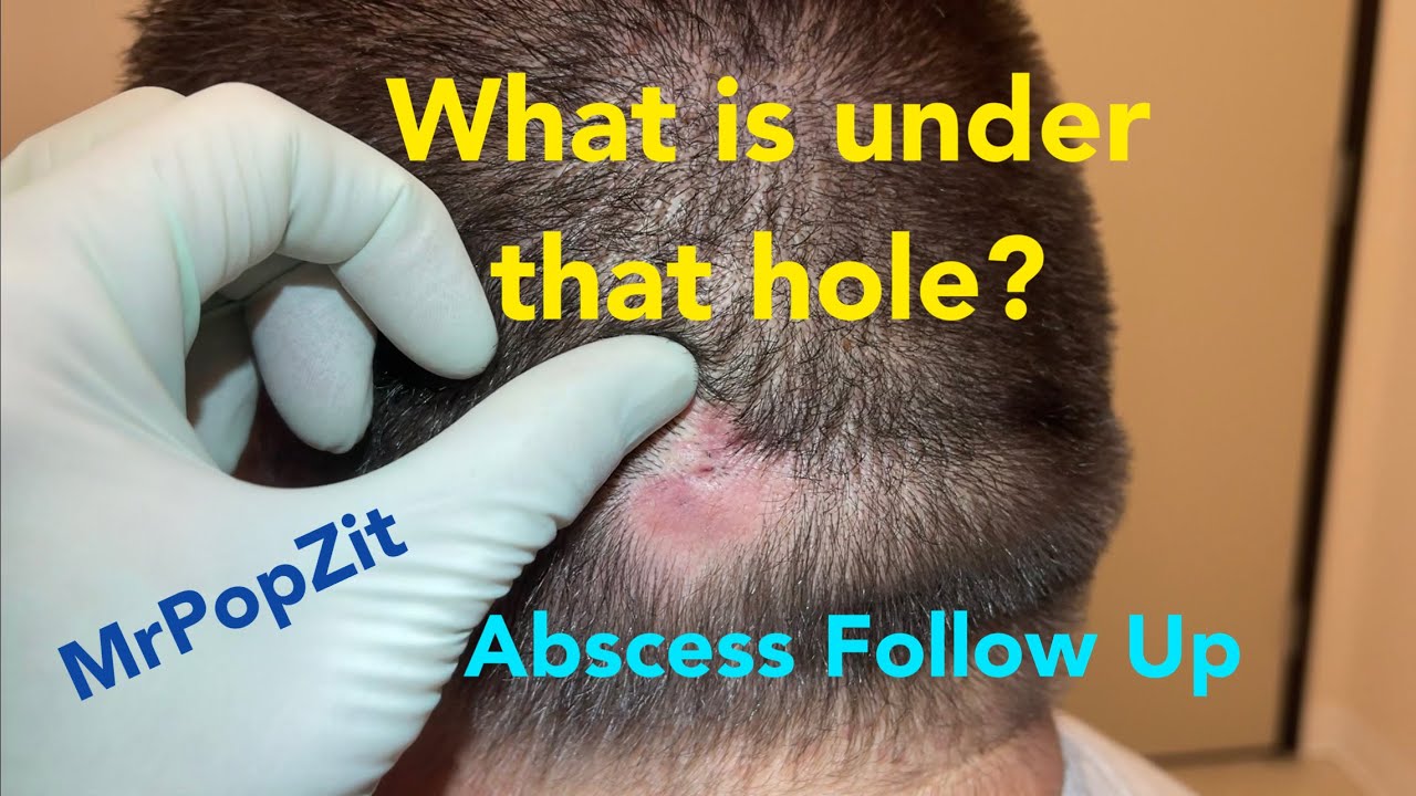 What is under that enlarged pore!? Large abscess follow up, cyst has ...