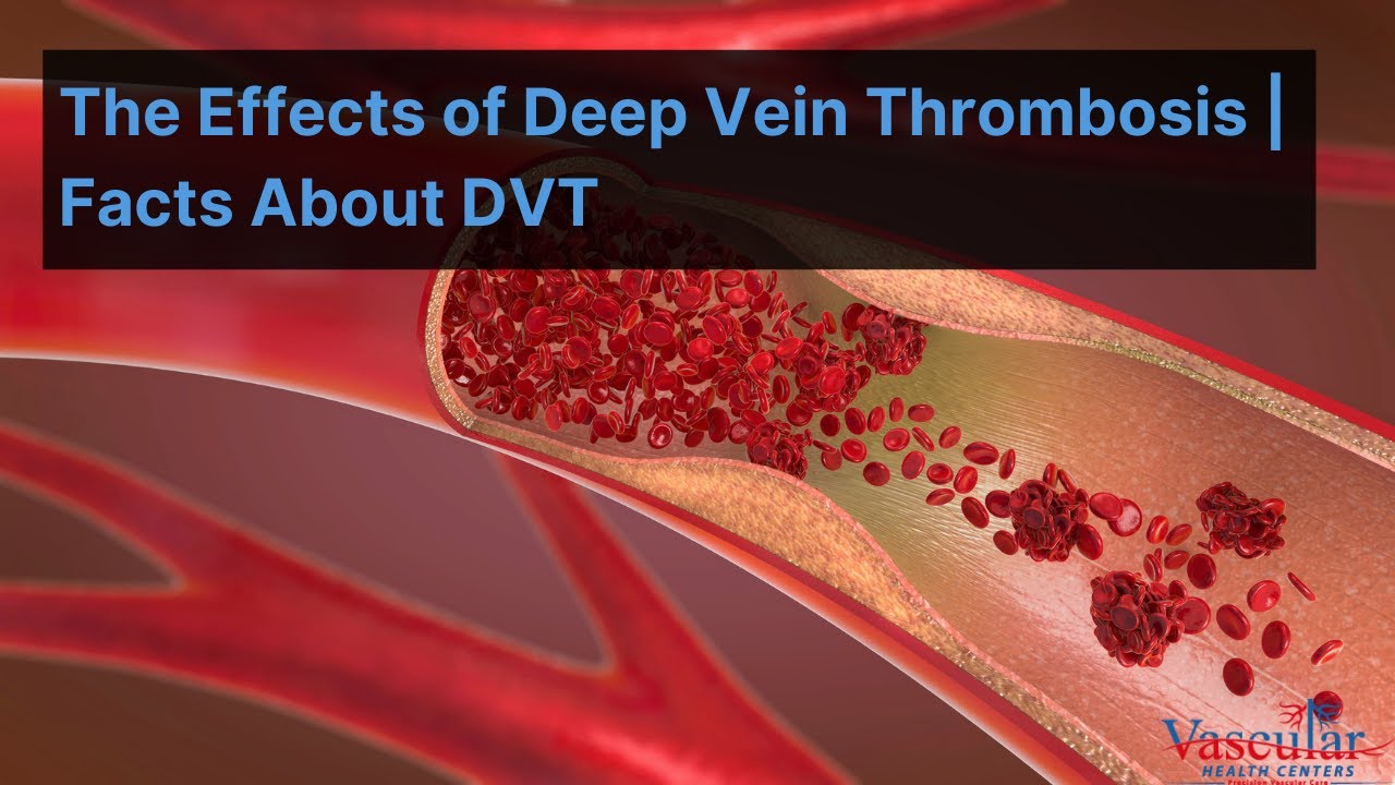 The Effects of Deep Vein Thrombosis | Facts About DVT - YouTube