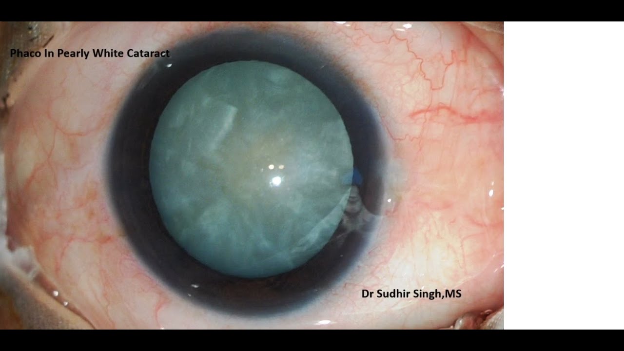 Unlocking the Secrets of Reverse Chop: Pearly White Intumescent ...