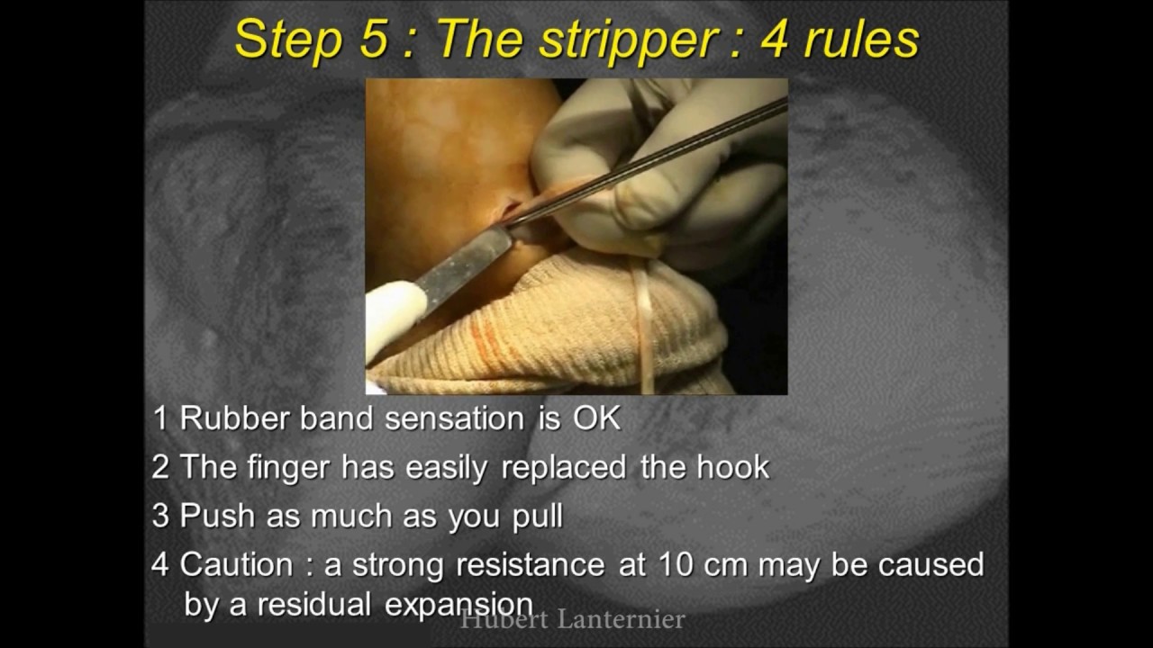 Hamstrings Harvesting : The Safe Procedure - YouTube