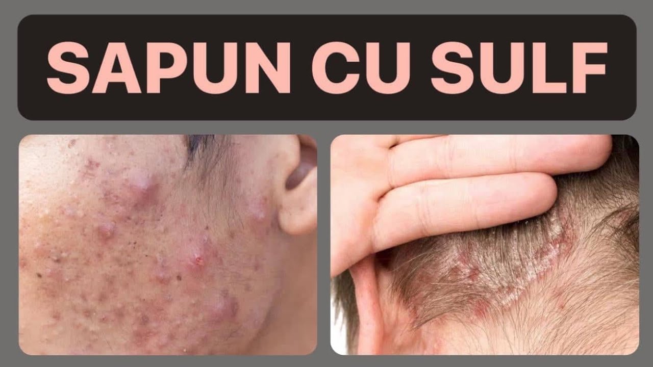 SAPUN CU SULF, pentru acnee si psoriazis - YouTube