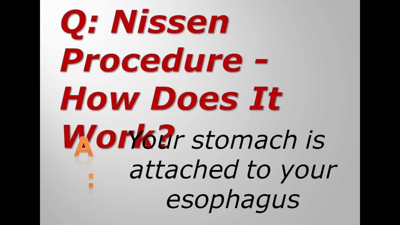 Nissen Procedure - How Does It Work? - YouTube