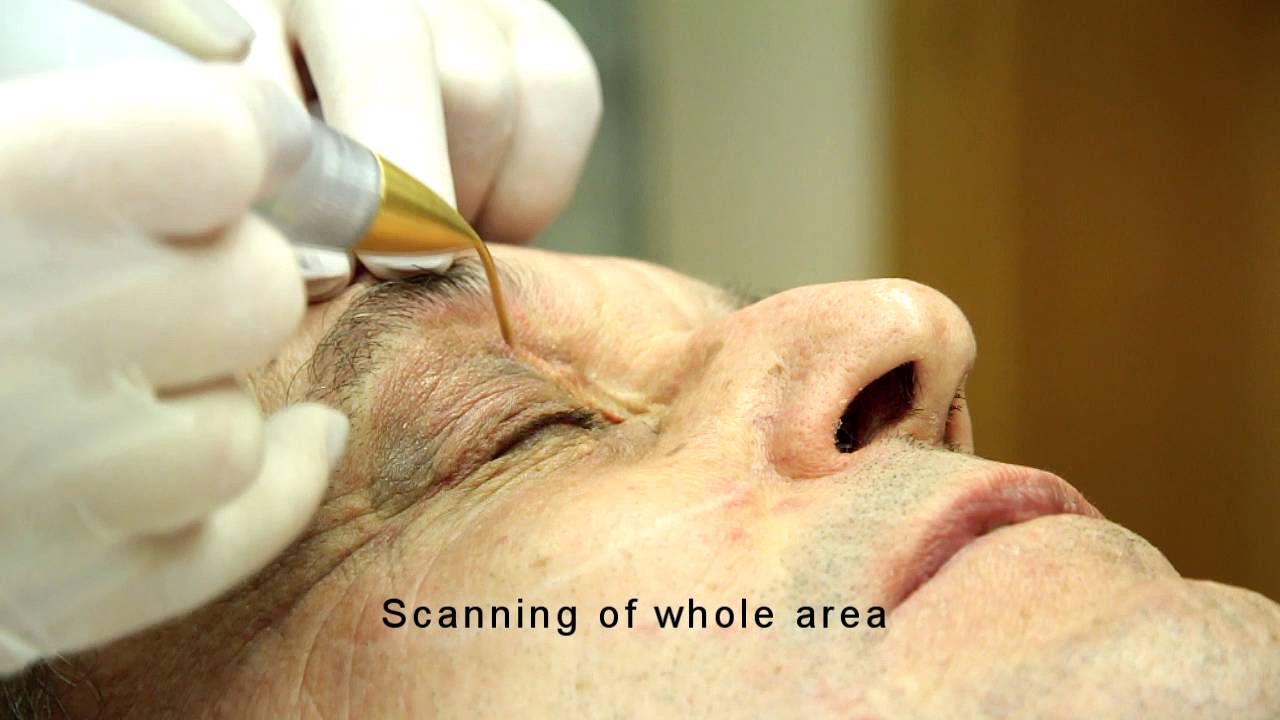 Jett Plasma Lift Medical - Blepharoplasty (noninvasive) - YouTube