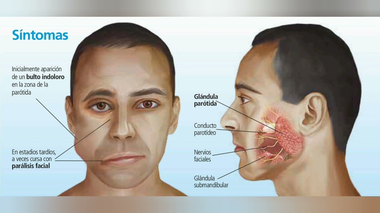 Glándulas Salivales Submandibulares Inflamadas