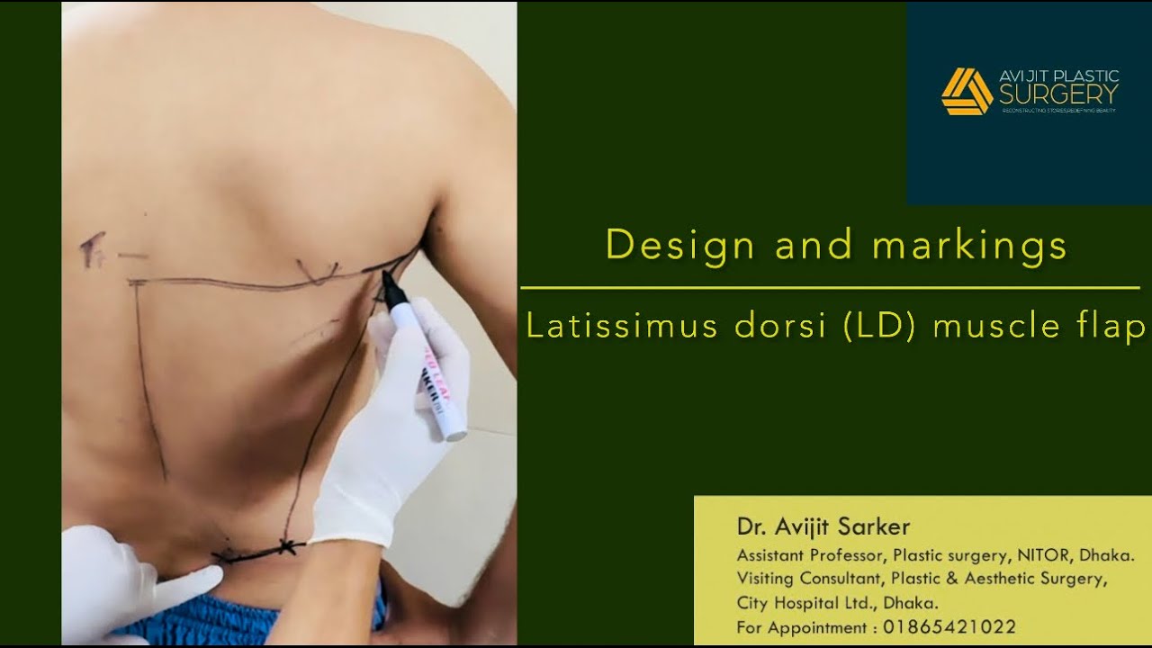 Latissimus dorsi( LD) muscle flap: Markings and Designs - YouTube