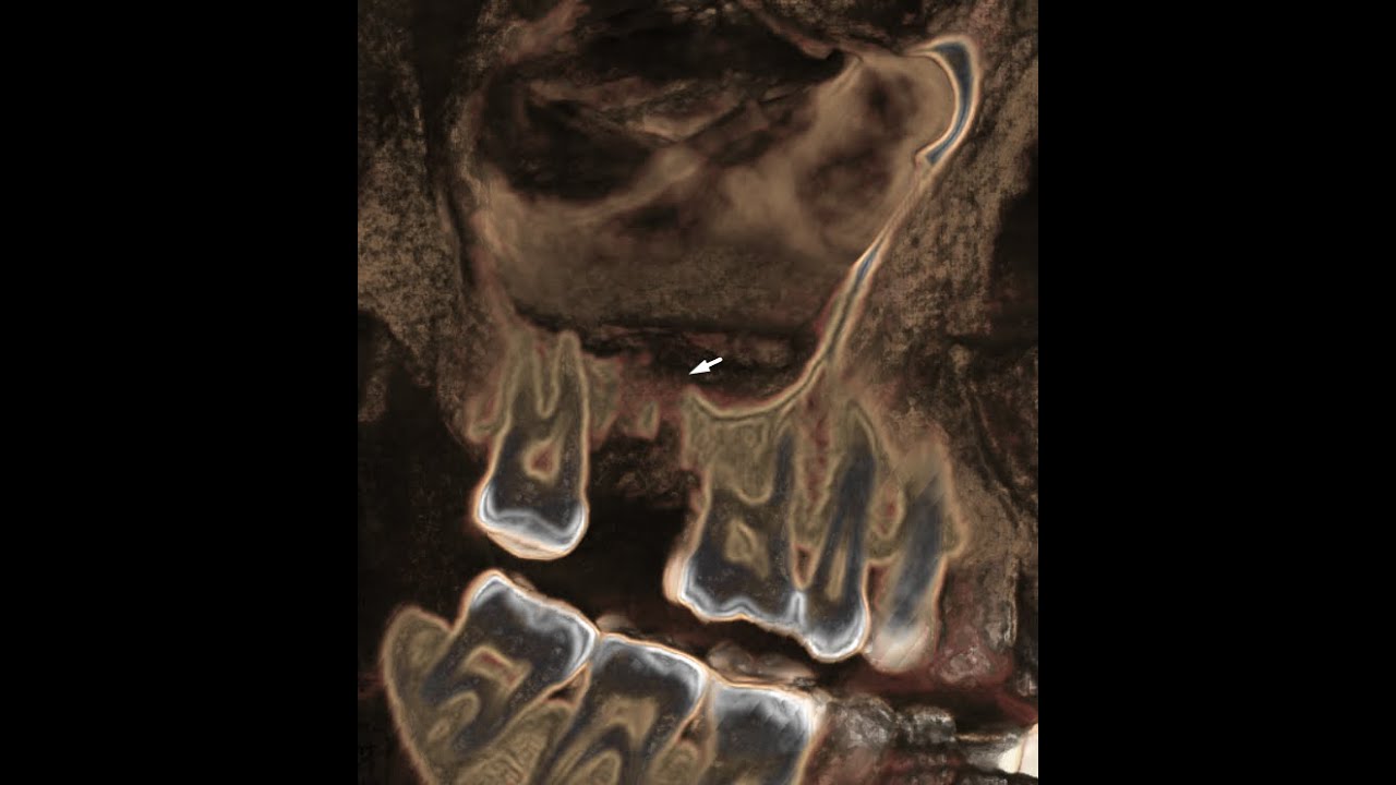 CBCT of Oro Antral fistula | ODC imaging - YouTube