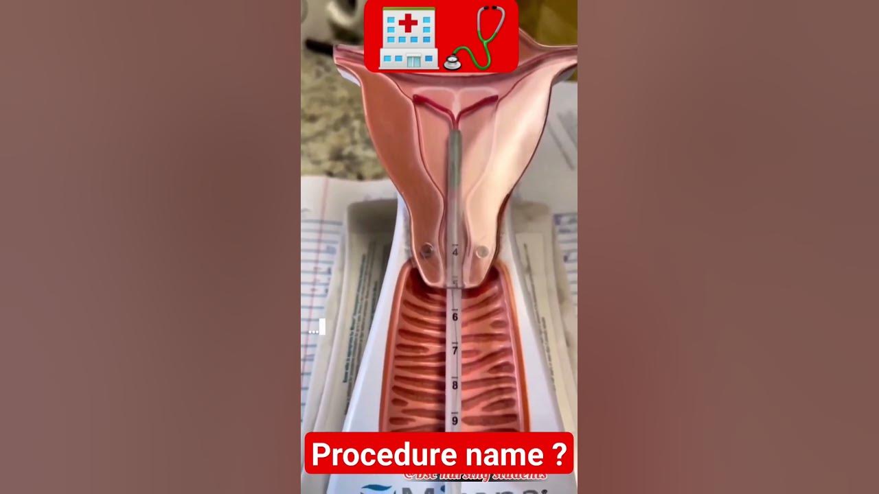 Iucdcopper Tcoppert Medicallife Hospital Youtubeshorts Subscribe Youtube
