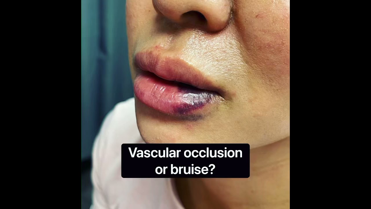 Vascular Occlusion Vs Normal Bruising After Lip Fillers - Infoupdate.org