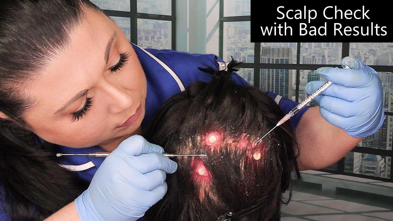ASMR Scalp Check with Bad Results (Acne Removal, Scalp Treatment ...