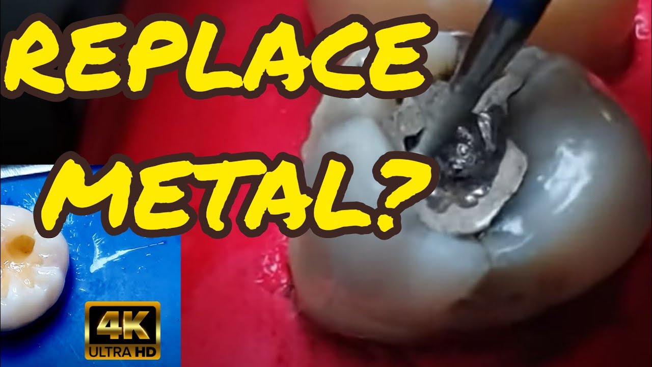 4K Removed METAL! BUT the tooth is gone!! Look - YouTube
