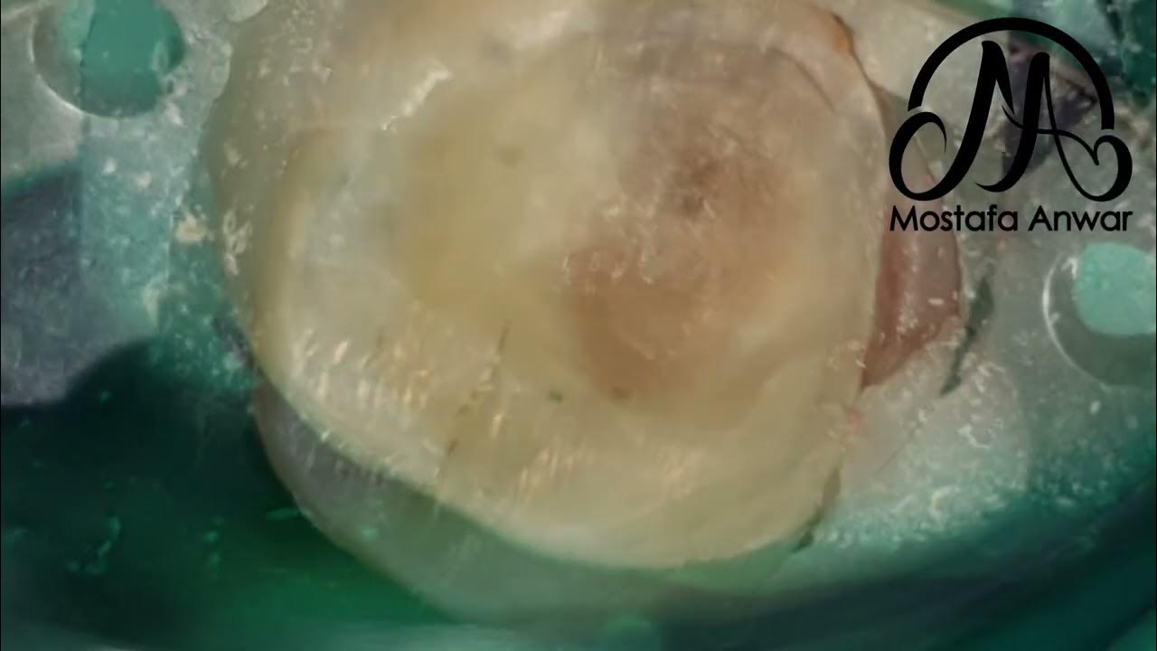 MTA Direct Pulp Capping using MAP SYSTEM in Lower Third Molar | Vital ...