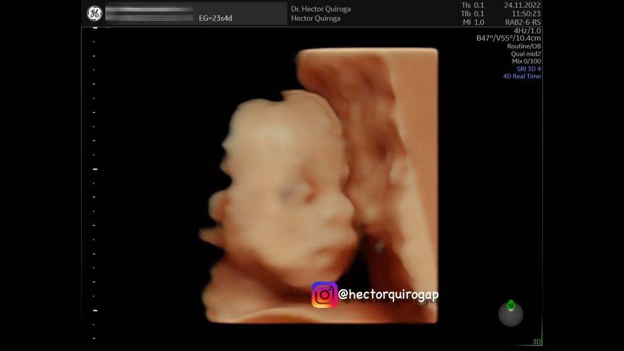 Ultrasonido 5D con HD Live en un embarazo de 23 semanas y 4 días. - YouTube