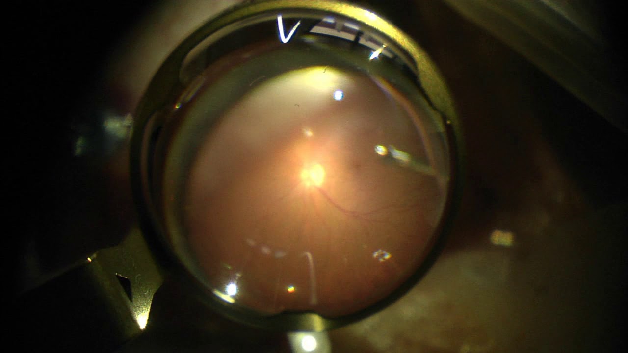 PPV endolaser OD 2020 05 19 133156 - YouTube