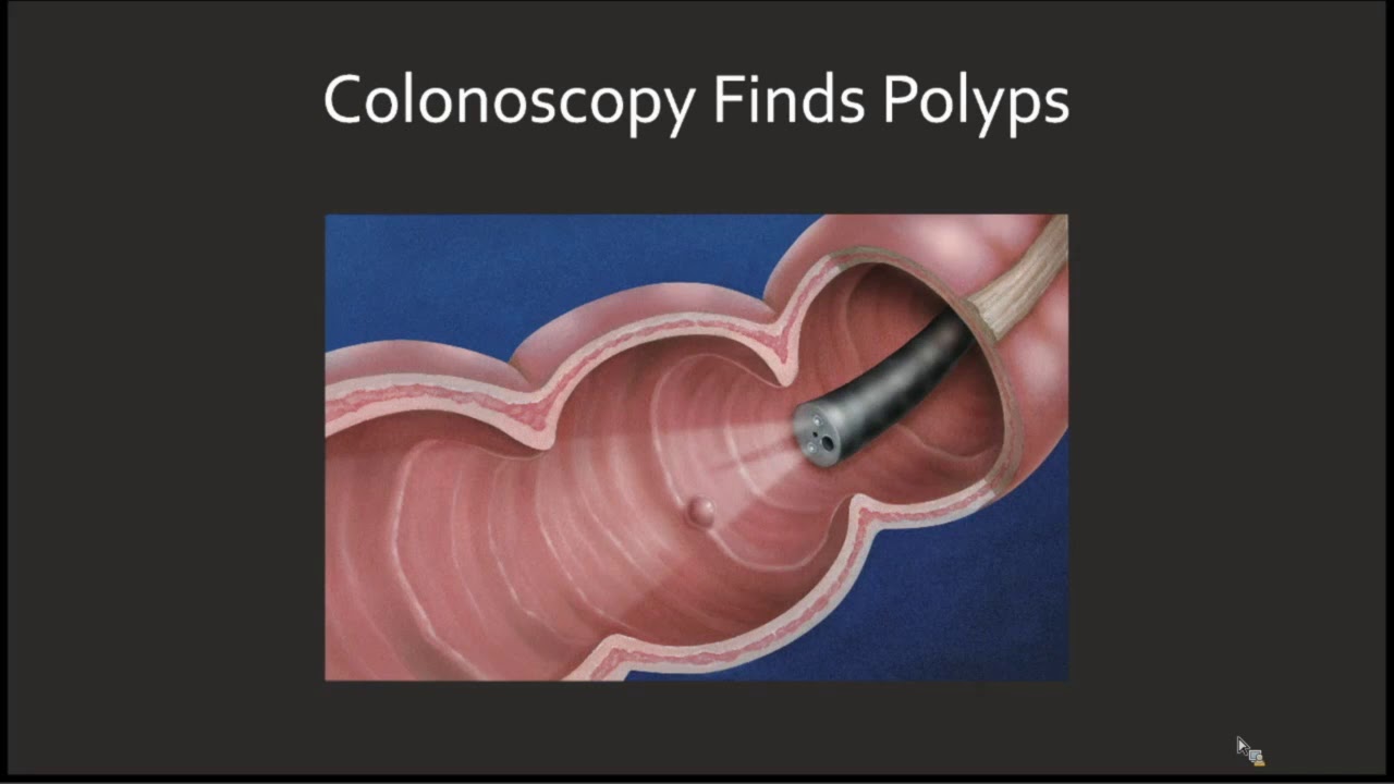 Quality In Colonoscopy Progress In Colon Cancer Prevention YouTube quality-in-colonoscopy-progress-in-colon-cancer-prevention-youtube
