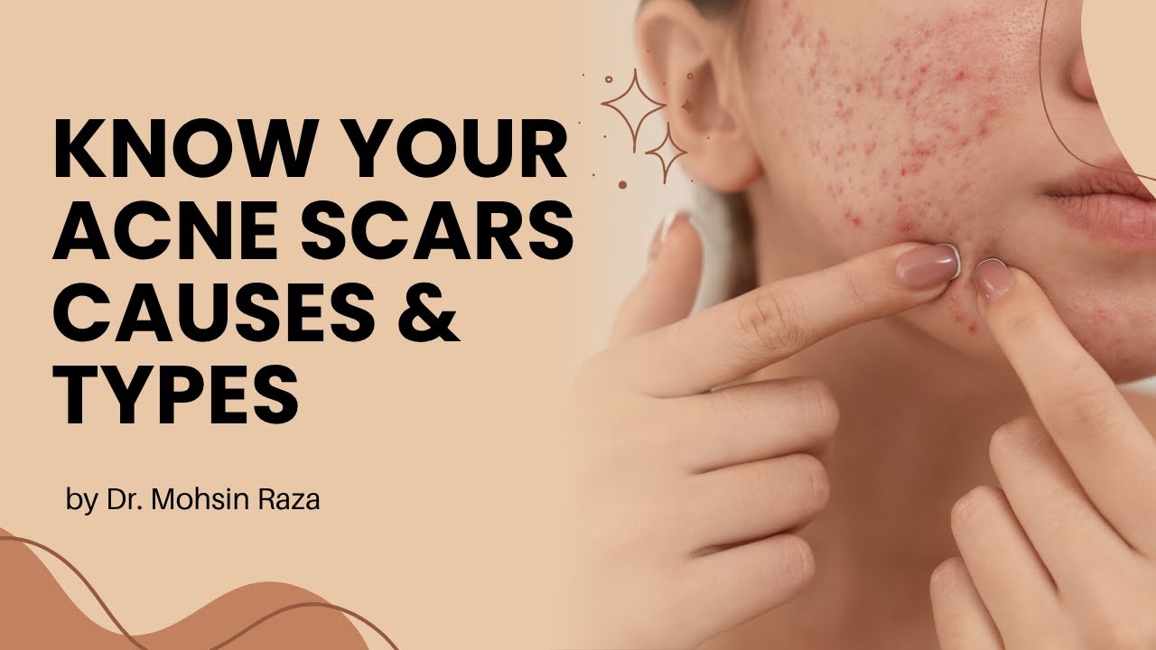 Causes and Types of Acne Scars | Explained by Dermatologist Dr. Mohsin ...