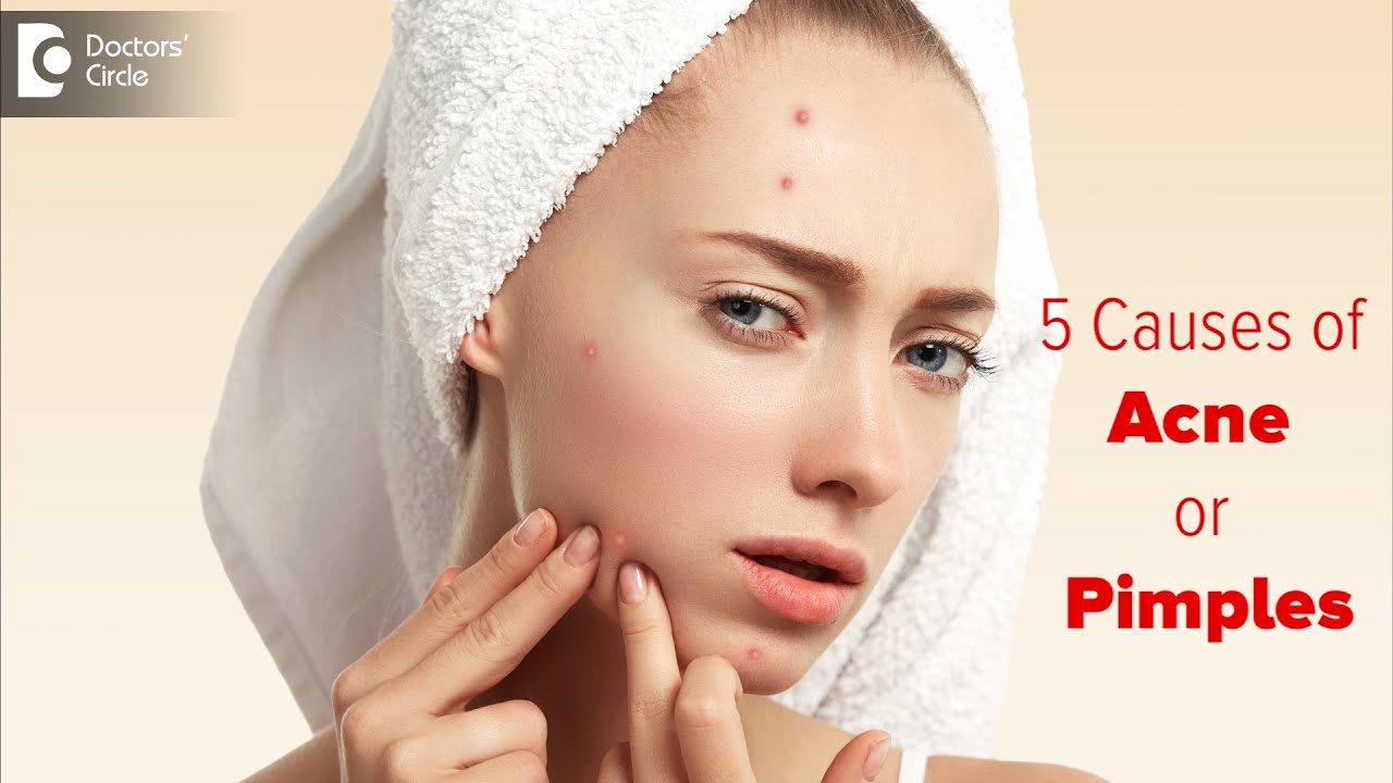 Why do I get ACNE? 5 Top Causes of Acne| Role of Hormones & Genes-Dr ...
