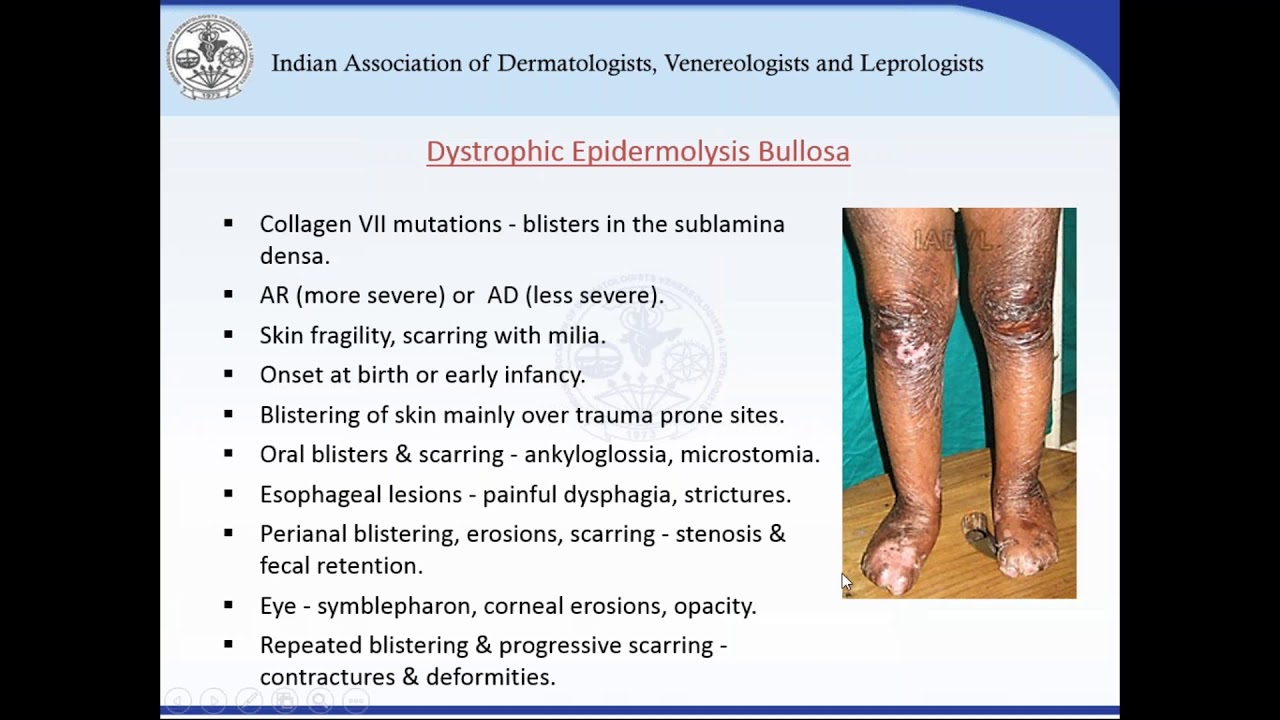 Dermatology Bullous disorders 🖇 Diagnosis bullous disorder of skin ppt ...