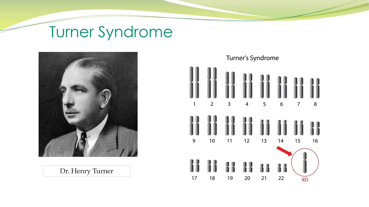 Congenital Chromosomal Birth Defects: Description and Rate - YouTube