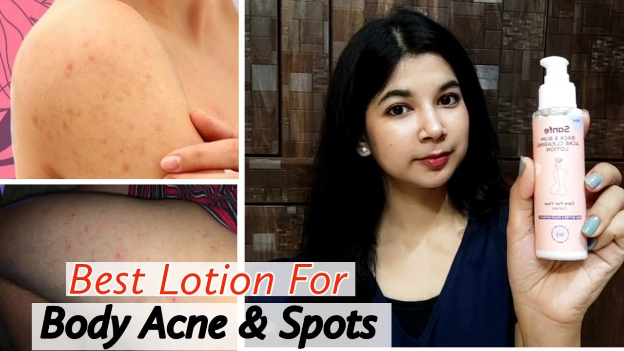 Best Lotion For Body Acne & Spots/Sanfe Back and Bum Acne Clearing ...