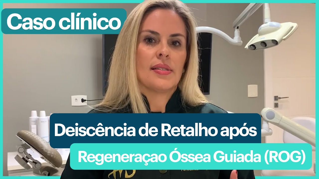 Caso clínico | Deiscência de Retalho após regeneração óssea guiada (ROG ...