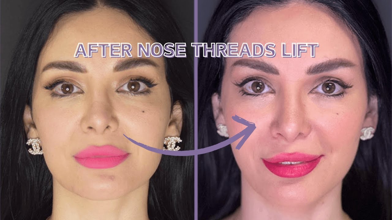 Without Surgery Nose Reshaping| Advantages of Nose Thread Lift # ...