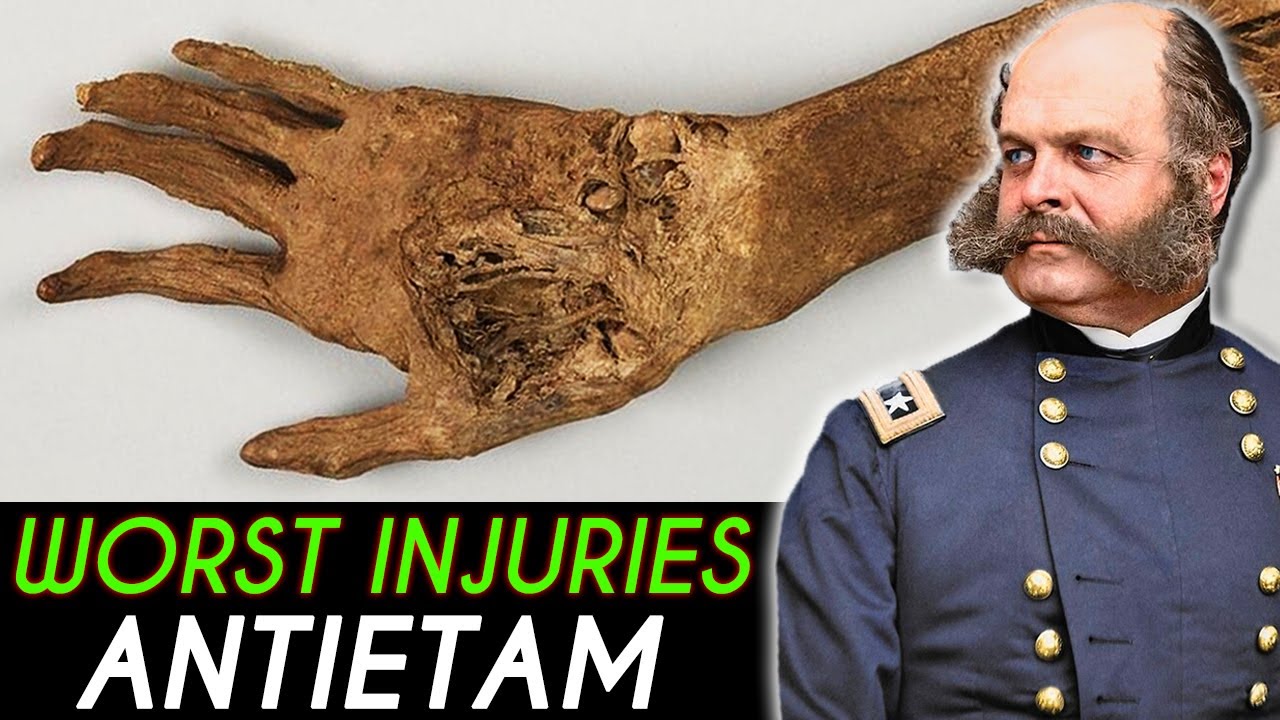 The WORST Wounds from the Battle of Antietam - YouTube