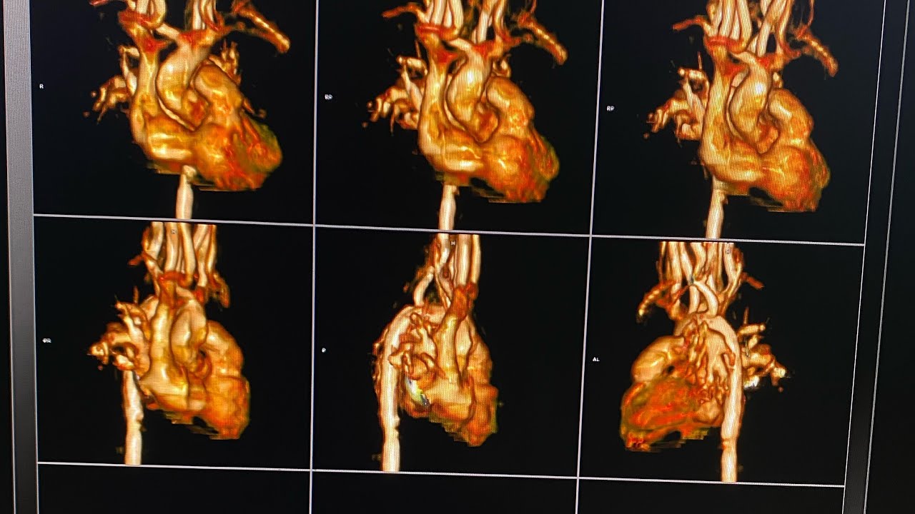 MRI Cardiac ( TOF) Time-of-flight Magnetic Resonance Angiography (TOF-MRA) - YouTube