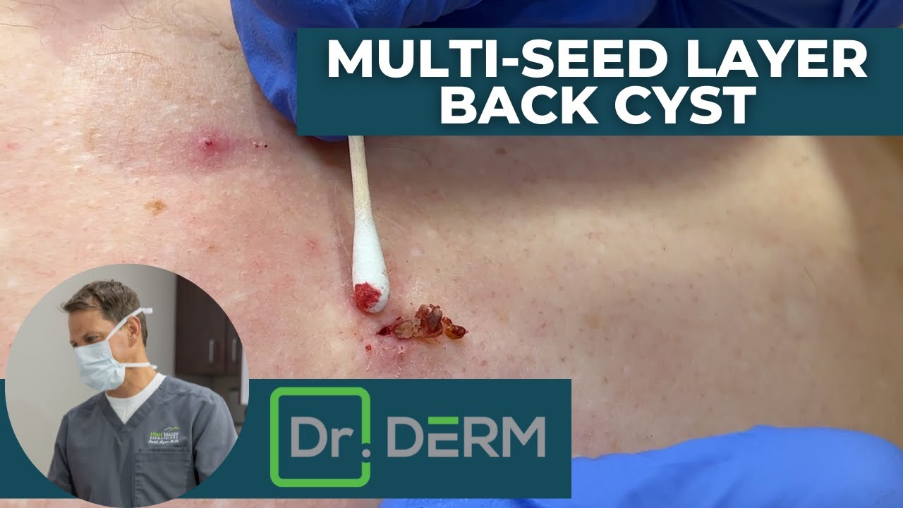 Multi-Seed Layer Back Cyst | Dr. Derm - YouTube