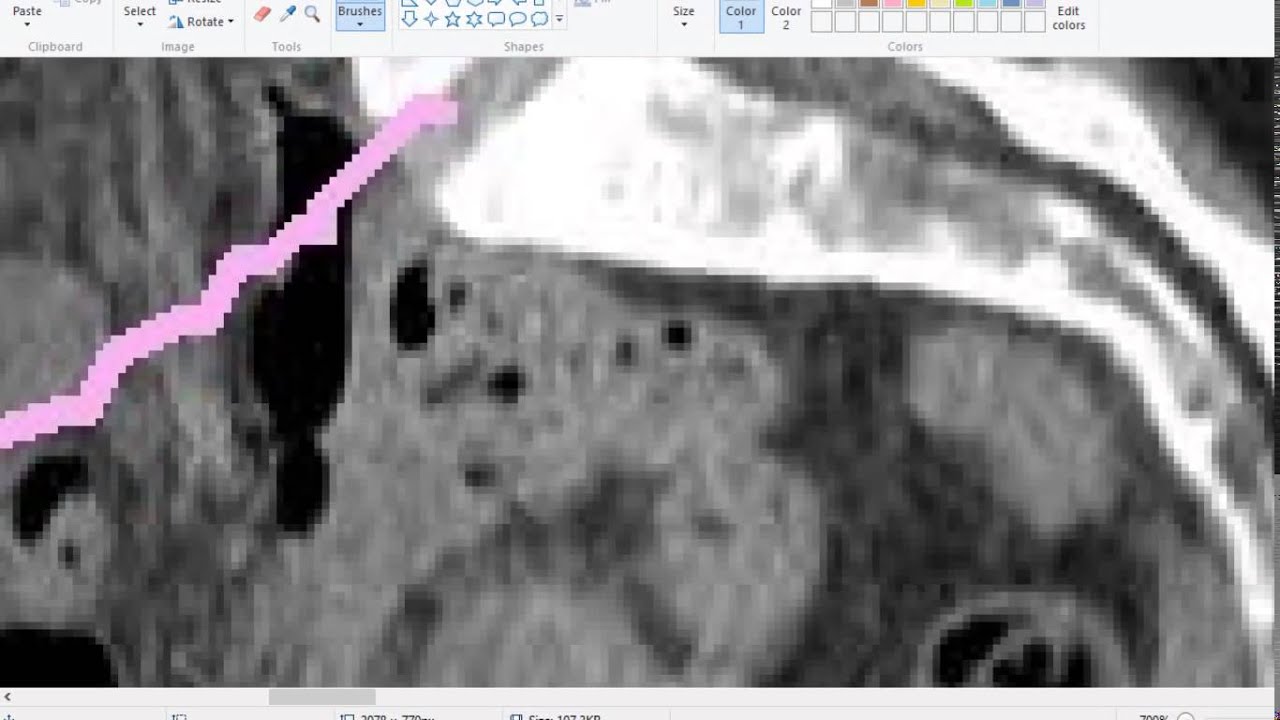 Lumbo sacral angle on one image AND then the other image. ? - YouTube