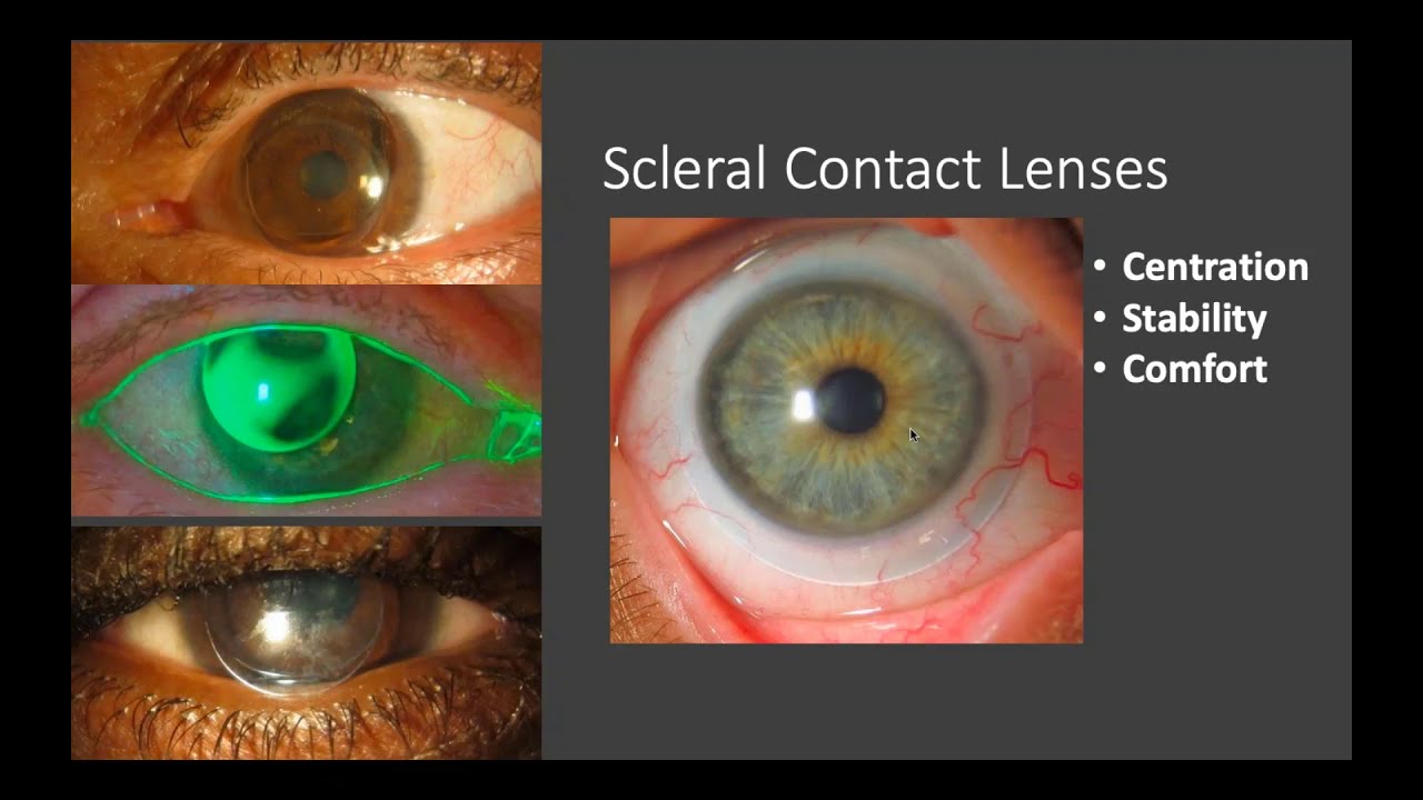 How To Fit Sclerals 071320 Youtube