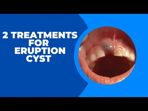 Eruption Cyst Treatment Eruption Cyst Treated With Diode Laser: A Case