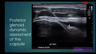 Ultrasound Inf Glenohumeral Lig in Adhesive Capsulitis of the Shoulder