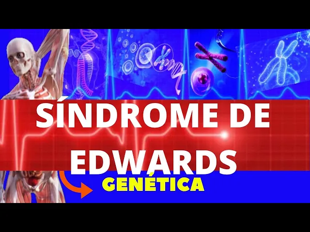 SÍNDROME DE EDWARDS - TRISSOMIA 18 (O QUE É, CAUSAS CARACTERÍSTICAS ...